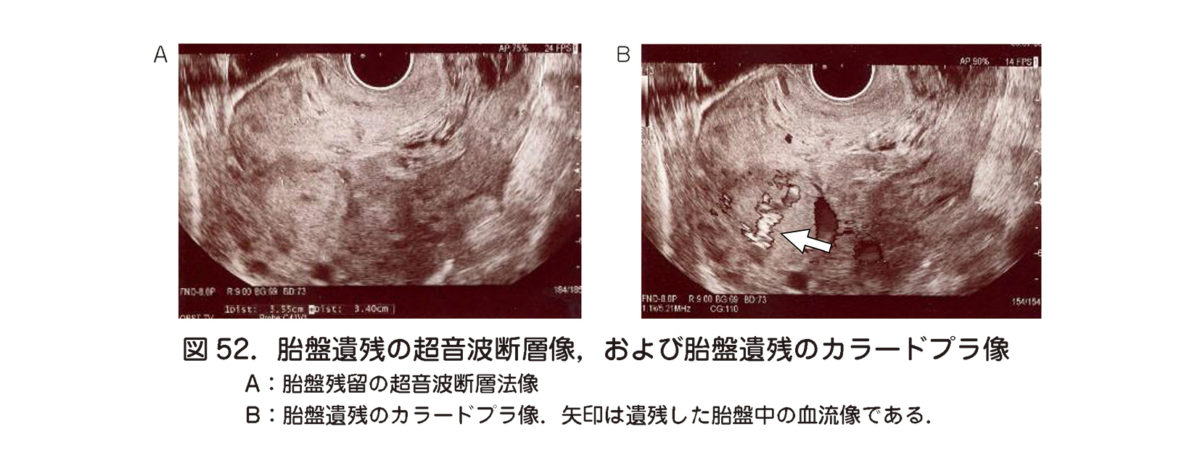 Q5．RPOC（retained products of conception）による出血に対する対応は？ – 日本産婦人科医会